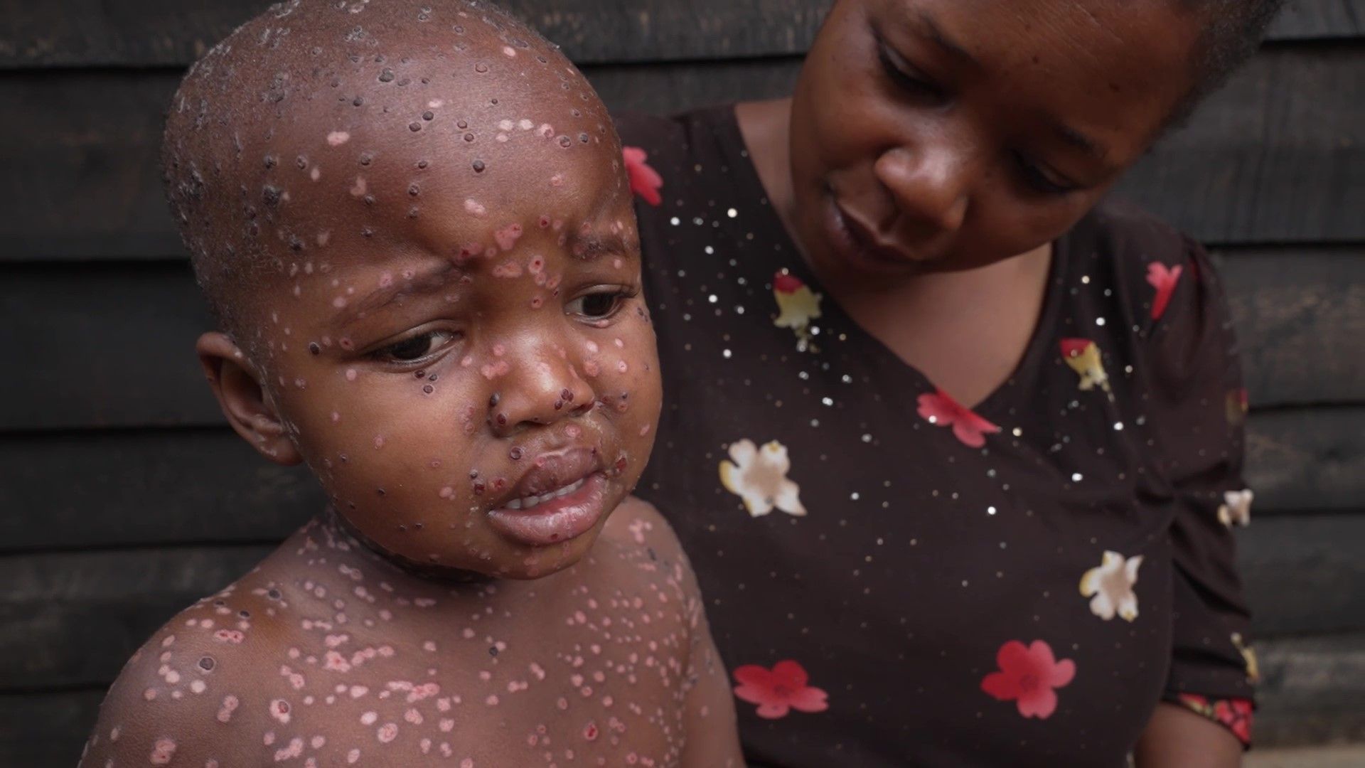 Mpox outbreak in DR Congo hits children hardest - GuardianTV Mpox outbreak in DR Congo hits children hardest - GuardianTV
